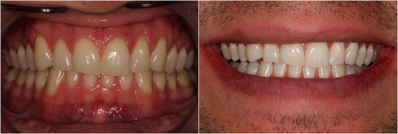 Teeth Whitening Columbus Dublin Ohio | Dublin Metro Dental Dublin Metro Dental Group