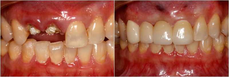 Dental Bridge - Temporary Dental Bridge | Dublin Metro Dental