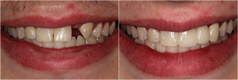 Dental Bridge - Temporary Dental Bridge | Dublin Metro Dental