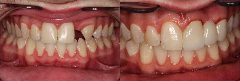 Dental Bridge - Temporary Dental Bridge | Dublin Metro Dental