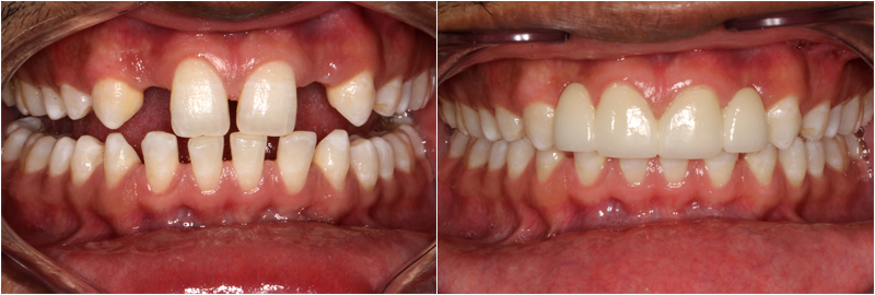 Dental Bridges Dublin Ohio | Dental Implants Bridges @ Columbus Ohio ...