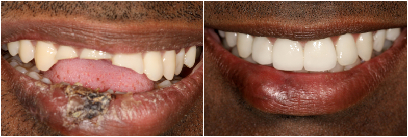 Dental Bridge - Temporary Dental Bridge | Dublin Metro Dental