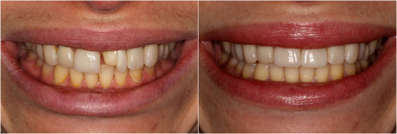 Affordable Dental Porcelain Veneers in Dublin - Smile Makeover - Dublin ...