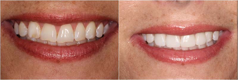 Affordable Dental Porcelain Veneers in Dublin - Smile Makeover - Dublin ...