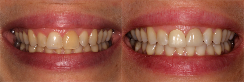 Porcelain Crown Dental Dublin | Dublin Metro Dental