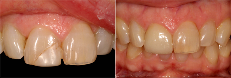 Porcelain Crown Dental Dublin | Dublin Metro Dental