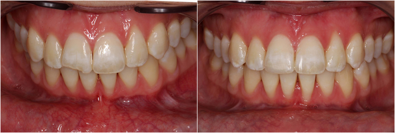 Affordable Tooth Bonding Dublin Ohio | Dublin Metro Dental